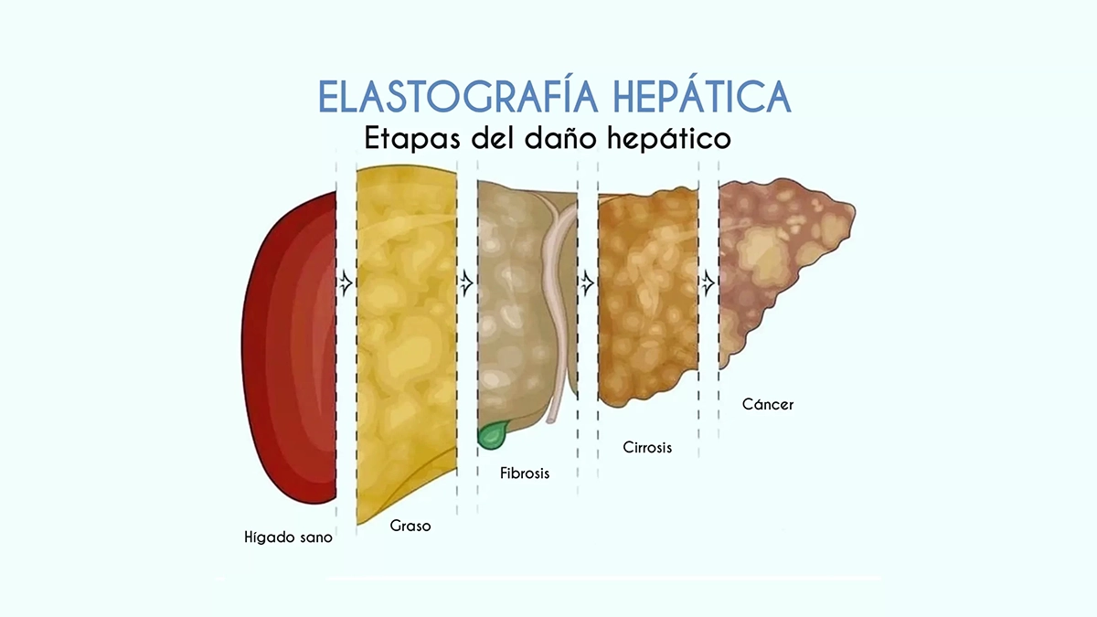 ¿EN QUE CONSISTE EL ESTUDIO DE ELASTOGRAFIA DE HIGADO POR ULTRASONIDO ...