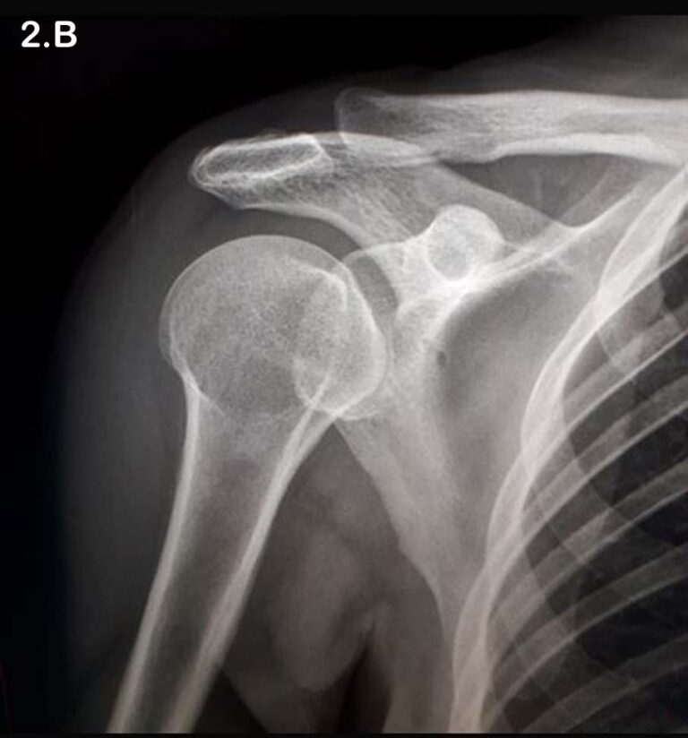 UTILIDAD DE LAS PROYECCIONES RADIOGRÁFICAS EN HOMBRO DOLOROSO - Body ...