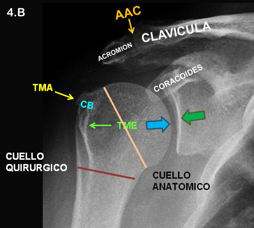 UTILIDAD DE LAS PROYECCIONES RADIOGRÁFICAS EN HOMBRO DOLOROSO - Body ...