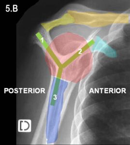 UTILIDAD DE LAS PROYECCIONES RADIOGRÁFICAS EN HOMBRO DOLOROSO - Body ...