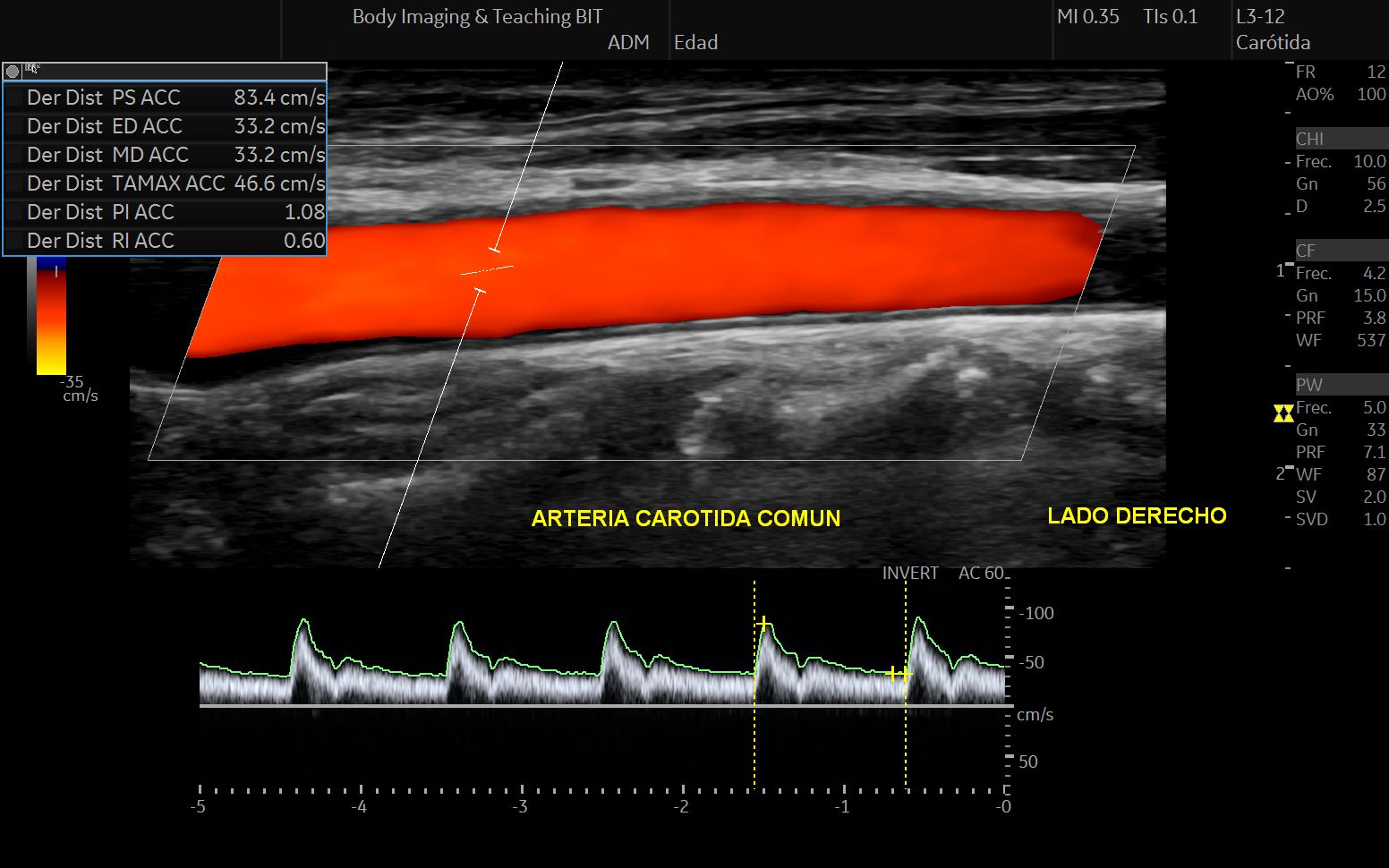 ¡Cuida tu corazón y tu cerebro! Conoce más sobre el estudio Doppler ...
